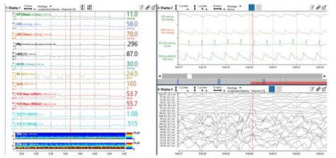 The Emerging Role Of Multimodality Neurologic Monitoring In Pediatric