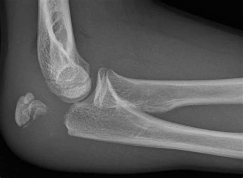 Olecranon Fractures Pathophysiology Management Teachmesurgery