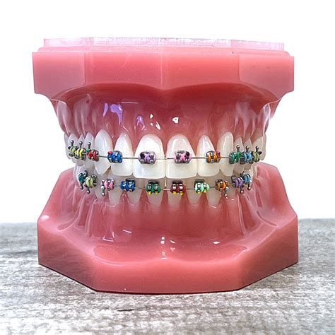 Damon Braces Colors Braces Types And How They Work For Teeth