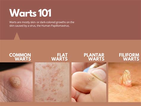 Genital Warts Vs Herpes Whats The Difference Nibwm