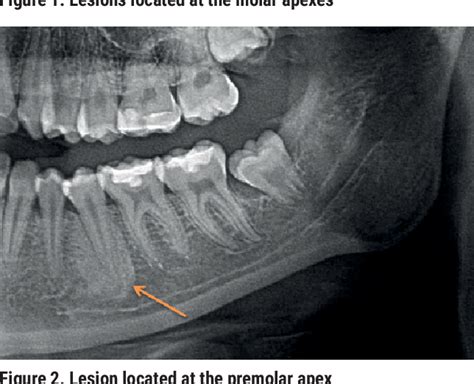 Figure 2 From Idiopathic Osteosclerosis And Condensing Osteitis In A Sample Of The Lebanese