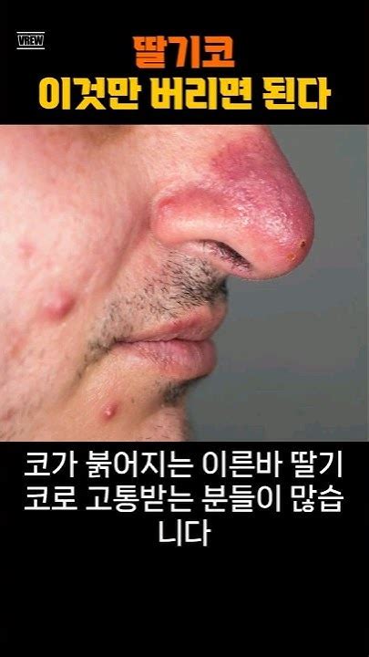 딸기코 코주사 주사치료법 딸기코 이것만 버리면 된다 Youtube