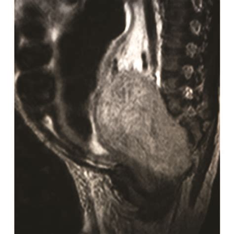 Rectal Duplication Cyst Download Scientific Diagram