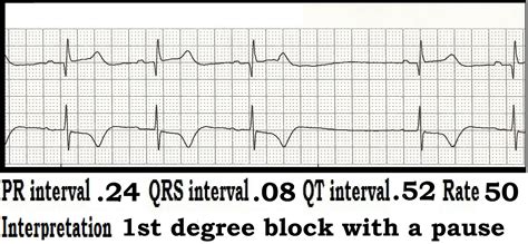 ECG Rhythm Strip Quiz Interval Measurements