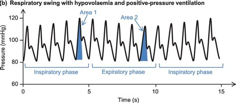 Chapter 35 Arterial Pressure Waveforms Anesthesia Key