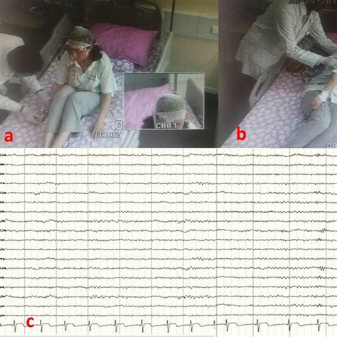 The Evaluation Of Psychogenic Non Epileptic Seizures PNES Cases With Saline Injection Method