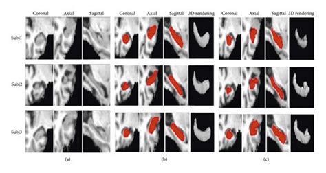 Hippocampal Image Patches A Without Patches Segmentation Labels B