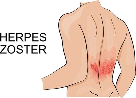 人类感染带状疱疹 花瓣网