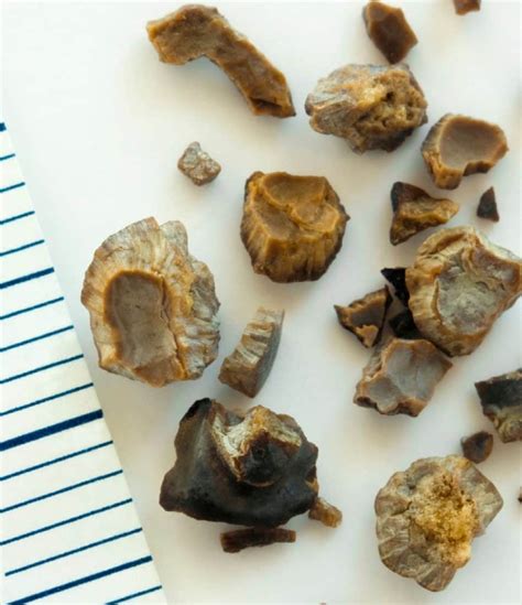 Piedras En Los Riñones Causas Síntomas Y Tratamiento La Guía De Las Vitaminas