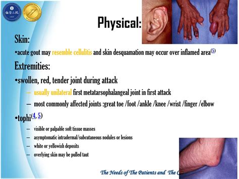 PPT Gout Causes Symptoms And Management PowerPoint Presentation Free Download ID 9305098
