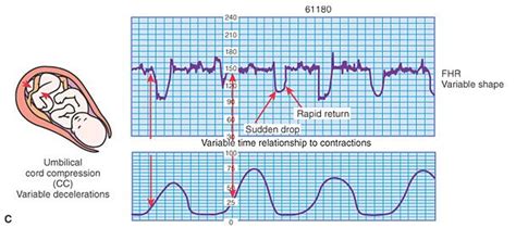 Variable Decelerations Caused By Conditions That Restrict Flow Through The Umbilical Cord The
