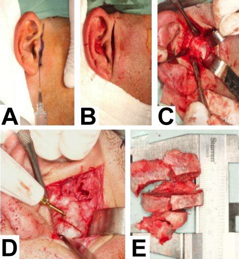 Surgical Procedure Being Initiated By Condylectomy A Demarcation Of