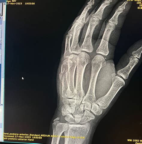 Musaab Bashir Mustafa On Linkedin Segmented Fracture Of The Left Fifth