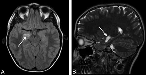 Pituitary Mri
