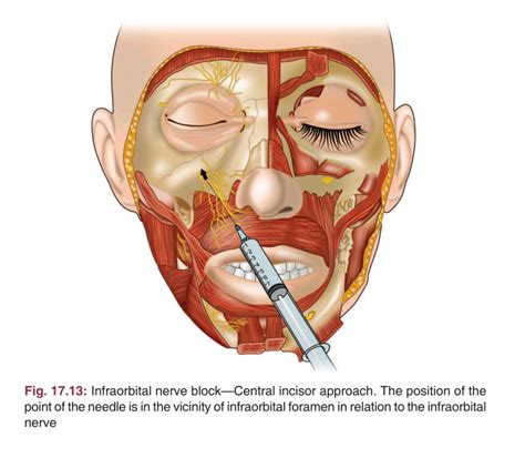 Infraorbital Nerve Block Landmarks Facial Nerve Blocks Core Em
