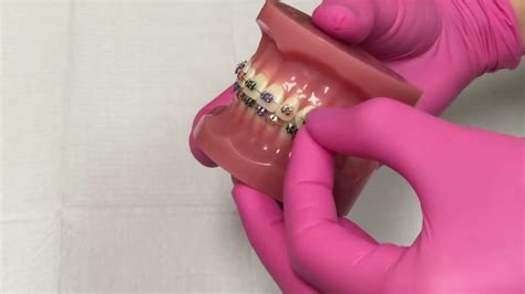 Class Ii Elastics Youtube