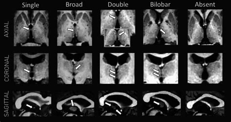Exploring The Impact Of The Interthalamic Adhesion On Human Cognition