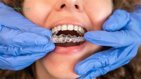 5 Reasons To Consider Invisalign With Attachments