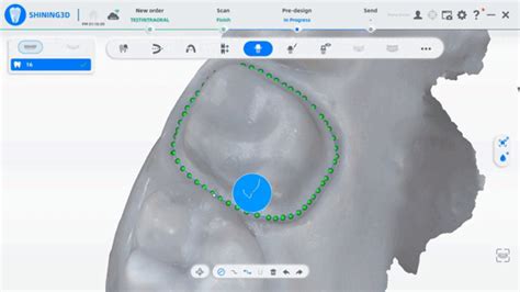 Extraction Of Marginlines Dental Support