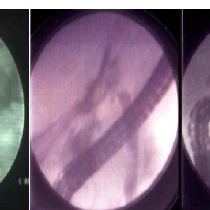 ERCP Showing CBD Structure Treated By Dilation And Senting Download
