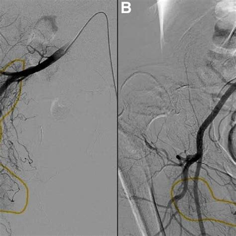 A Intraoperative View Of Hip Disarticulation Surgery And Anterior