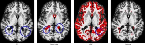 Freesurfer Ms Segmentation Results The First Column Shows A Slice From Download Scientific