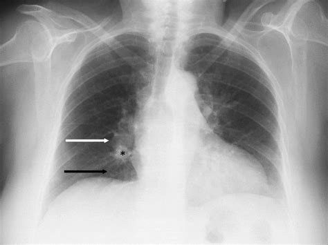 Pulmonary Embolism X Ray Asymptomatic Pulmonary Embolism Secondary To
