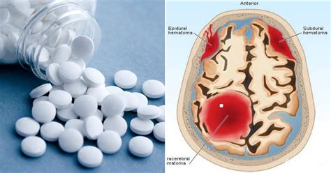 Taking Aspirin Increases Risk Of Bleeding In The Skull Especially Among People Without Heart