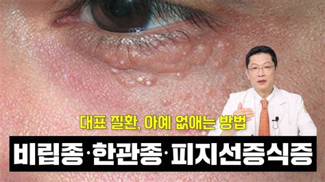 눈가에 생긴 좁쌀 여드름이 사실은 피부 질환 한관종 비립종 구분하는 방법 Youtube