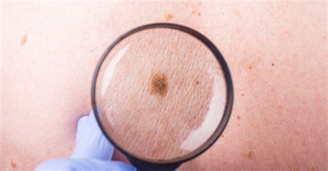 Recognizing The Early Warning Signs Of Melanoma