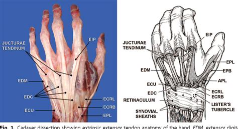 Extensor Tendon Hand