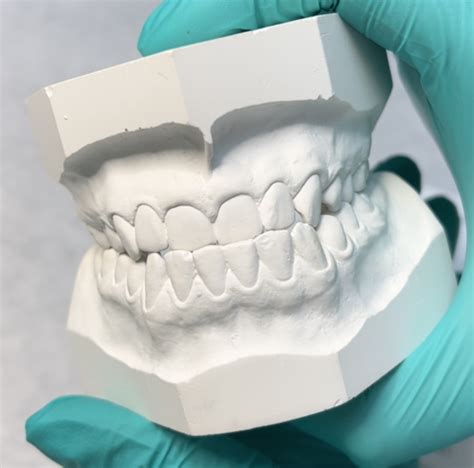 Occlusion Flashcards Quizlet