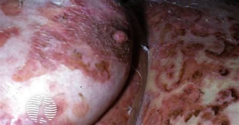 Pemphigus Vulgaris Image