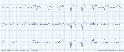 Sgarbossa Criteria Advanced Cardiac Diagnosis Pmcardio