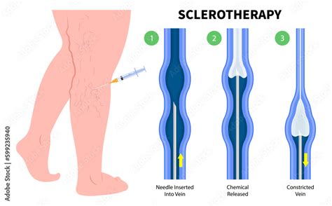 Medical Anatomy Vascular Artery Disease Varicose Vein Phlebectomy Or