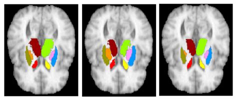 2d Slice Segmentation Ibsr Left Groundtruth Middle Rf Based Download Scientific Diagram