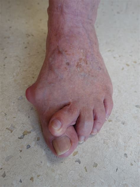 Cross Over Toe Deformity