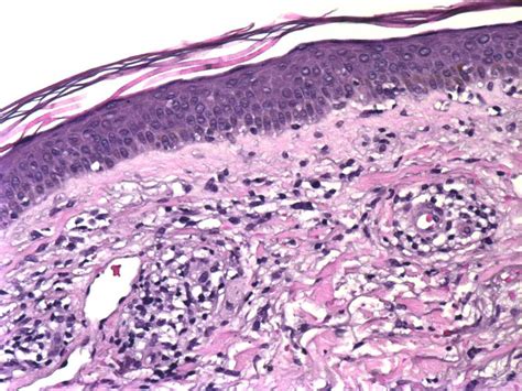 Capillaritis As A Potential Harbinger To Cutaneous T Cell Lymphoma