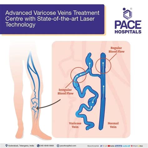 Pace Hospitals — Varicose Veins Treatment In Hyderabad India By Pace