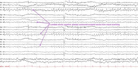 Lambda Is A Benign Variant Seen In Eeg Recordings With A Positive