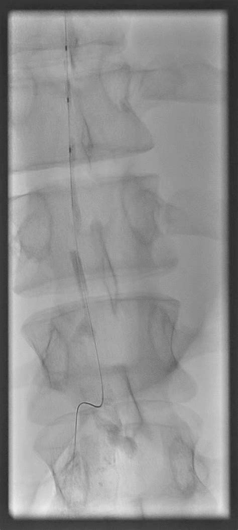 Repeat Thoracic Duct Embolization In Traumatic Thoracic Duct Injury An