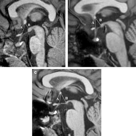 Anterior Third Ventricle Shapes On Midsagittal Three Dimensional 3 D