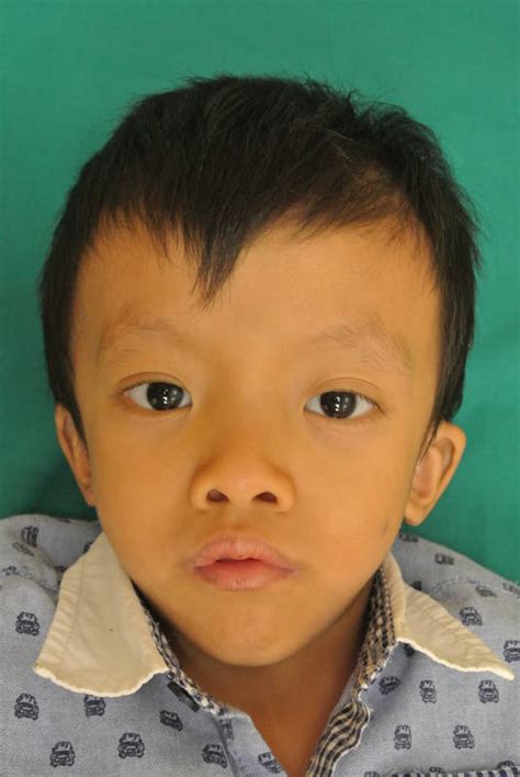 Noonan Syndrome Atlas Of Human Malformation Syndromes In Diverse
