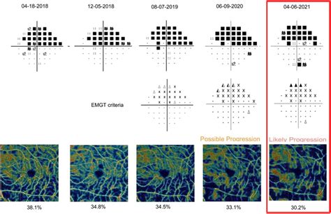 representative case of a 69 year old female [baseline visual field vf