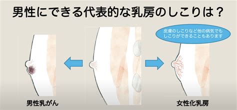 【男性乳がん】男性の乳房にしこりができたらどうする？【女性化乳房・男性乳癌を解説】｜乳がん大事典｜bc Tube｜複数人の乳腺科医による制作・監修