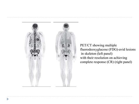 Multiple Myeloma Clinical Features And Presentation Pptx