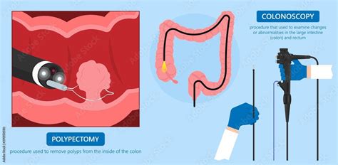 Polypectomy Procedure To Remove Polyps From The Colon Medical Stock Vector Adobe Stock