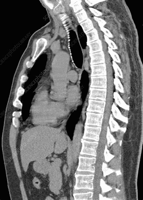 Chest Ct Scan Stock Image C056 4351 Science Photo Library