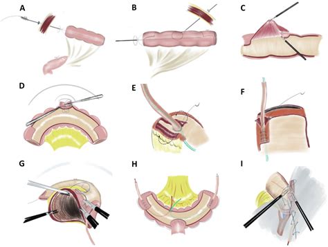 Initial Experience With Intracorporeal Laparoscopic Radical Cystectomy