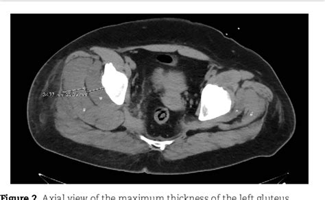 Figure 2 From Gluteal Compartment Syndrome After Laparoscopic Surgery In Lateral Jackknife
